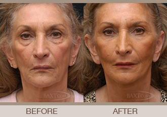 Fat Injection Gallery - BAXT CosMedical® #2
