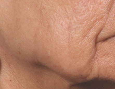 ellacor® Micro-Coring™ - BAXT CosMedical®