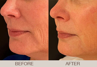 ellacor® Micro-Coring™ - BAXT CosMedical®