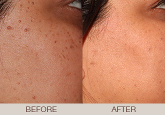Mole & Lesion Removal Gallery - 6 months post-procedure