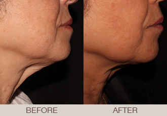 Ultherapy® Gallery - Ultherapy® skin tightening results by Dr. Baxt