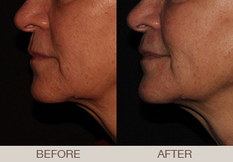 ellacor® Micro-Coring™ - Photos Taken 6 weeks after 1st treatment