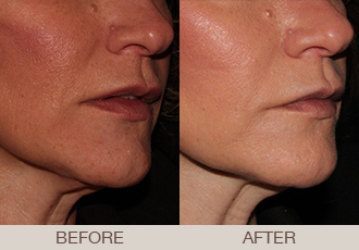 ellacor® Micro-Coring™ - BAXT CosMedical® 55-Year-Old Treatment