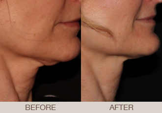 Before and After Ultherapy® Gallery - Paramus, NJ. 18636