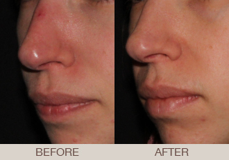 Vbeam Perfecta Gallery - BAXT CosMedical® Vbeam Laser to Angioma 18642