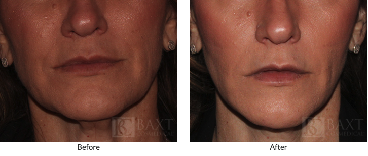 ellacor® Micro-Coring ™ - BAXT CosMedical®