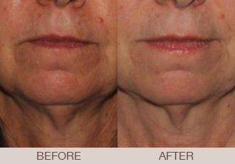 Before and After Ultherapy® Gallery - Paramus, NJ. 19342