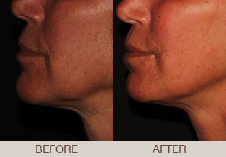 Ultherapy® Gallery Before and After Results - Paramus, NJ. 21435