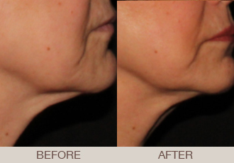 Ultherapy® Gallery Before and After Results - Paramus, NJ. 22181