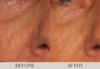 Ultherapy® Gallery Before and After Results - Paramus, NJ. 22188