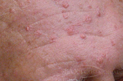 Smoothbeam Laser Treatment For Sebaceous Hyperplasia - The Best Picture ...